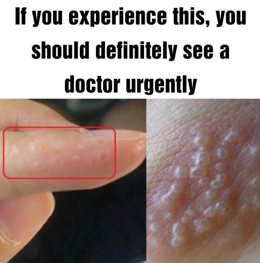 If you see these painful red bumps, you may have dyshidrotic eczema ...